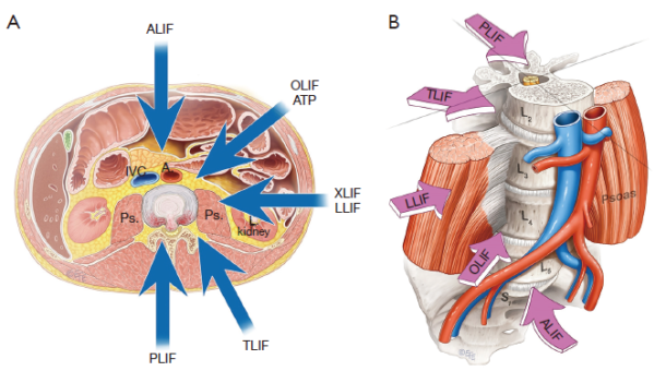 Saphenous SSEP During Transpsoas Lateral Interbody Fusion