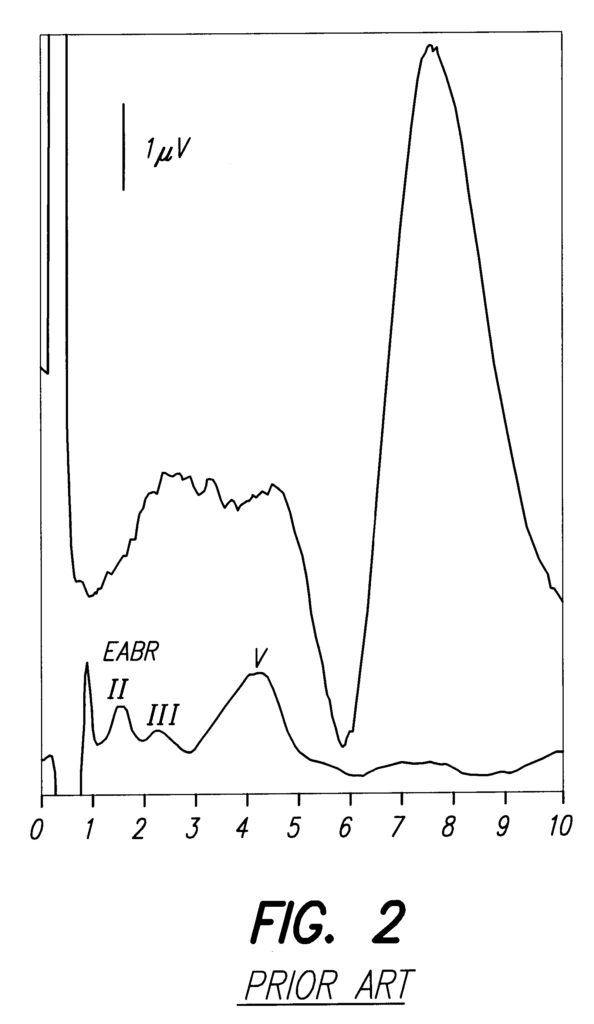 Post-Auricular Muscle Artifact Or Middle Latency ABR